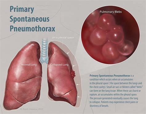 Pneumothorax Flashcards Quizlet