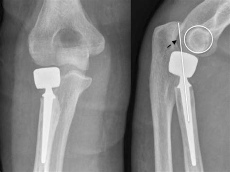 Radial Head Fractures Trauma Orthobullets Vrogue Co
