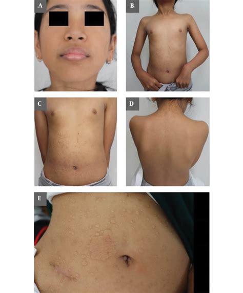 Primary Anetoderma In An Infant A Case Report From Southeast Asia