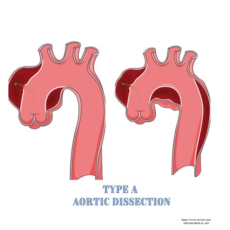 Aortic Dissection Vascular Info
