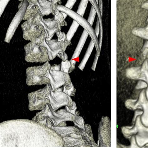 Three‐dimensional Computed Tomography Reconstructed Three‐dimensional