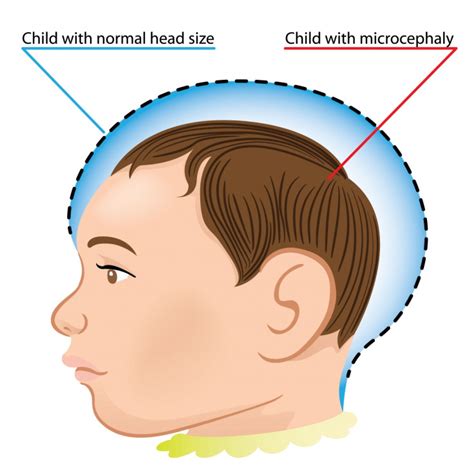 Microcephaly Everything You Need To Know About The Neurological