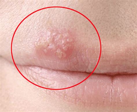 헤르페스 바이러스 감염 알츠하이머병 위험 약 2배