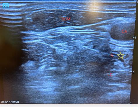 Ultrasound Guided Stellate Ganglion Block At The Level Of C6 Transverse Download Scientific