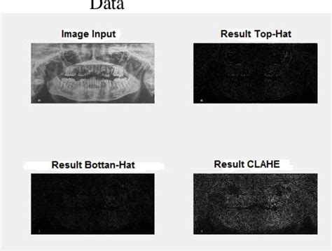 Figure 3 From Segmentation And Counting The Number Of Teeth Panoramic Dental Image Semantic