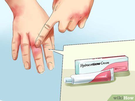 6 Ways To Treat Dermatitis WikiHow Health 6 Ways To Treat Dermatitis WikiHow Health