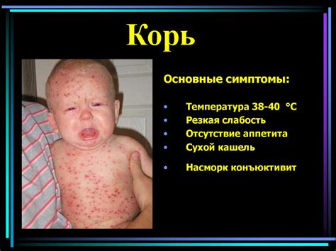 Дифференциальная диагностика инфекционных экзантем презентация онлайн