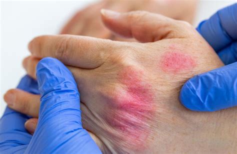 تطوير نموذج ذكاء اصطناعي لتشخيص مرض جلدي خطير Rt Arabic