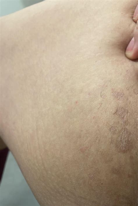 Sudden Discoloration Spots On Inner Thigh Rdermatology