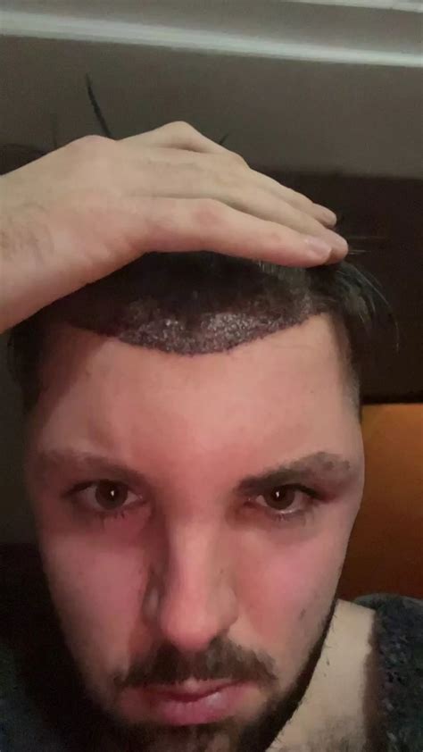 Man S Head Swells Like A Balloon As He Ignores No Sex Rule After Turkey Hair Transplant