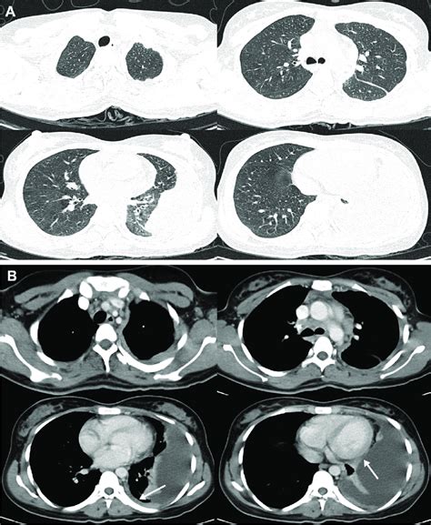 A Ct Chest Lung Window Showing No Evidence Of Consolidation Download Scientific Diagram
