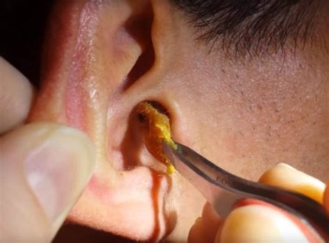Magnet Like Methods To Pull Out Old Earwax Quickly And Safely कान में