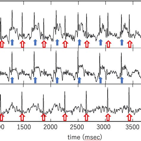 Top Panel Combined Fetal Signal From Twin Fetuses With Twin A Qrs Download Scientific