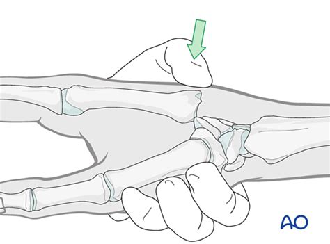 Orif For Dislocation And Fracture Dislocation Of The Carpometacarpal Joint