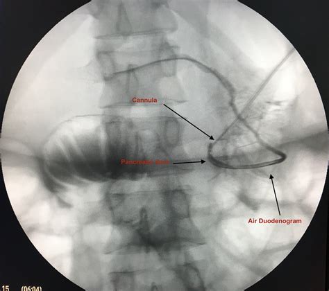 Annular Pancreas Ercp