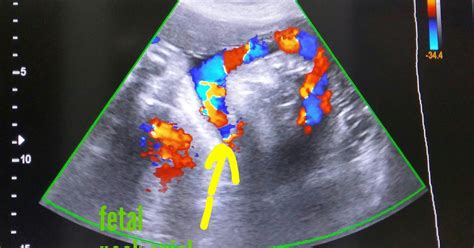 Ultrasound Imaging Nuchal Cord