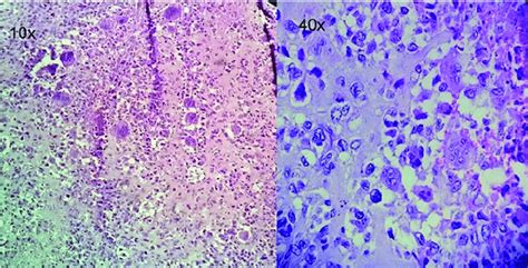 Hande Stained Section Show Large Osteoclast Like Giant Cells And Uniform