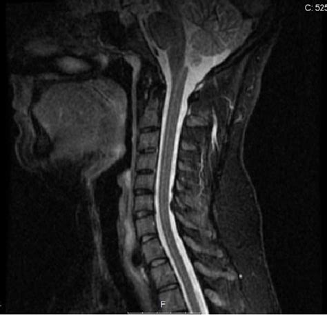 Mri Cervical Spine Without Contrast Showing Mild Multisegmental Download Scientific Diagram