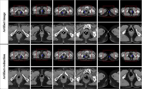 The Result Of Metal Artifacts Reduction For The Clinical Artifact Download Scientific Diagram