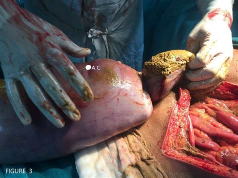 Hepatic Flexure With Big Proximal Perforation At The Junction Of Download Scientific Diagram