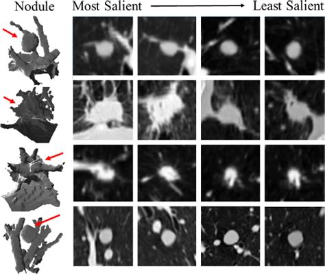 Figure 1 From A Lightweight Multi Section Cnn For Lung Nodule Classification And Malignancy