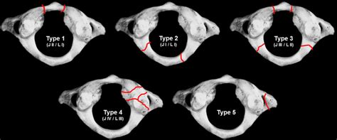 Jefferson Fracture Classification C1 Vertebral Jefferson Fractures Jefferson Fracture Classification C1 Vertebral Jefferson Fractures