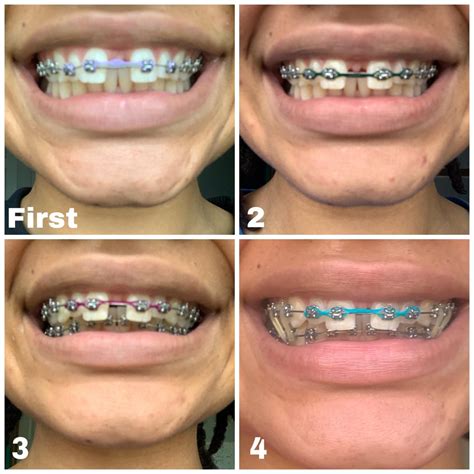 Progress Of Front Gap Closure ~3 Months So Far R Braces