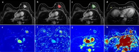 A 51 Year Old Female With Bi Rads 4c A Mass Was Clearly Identified In Download Scientific