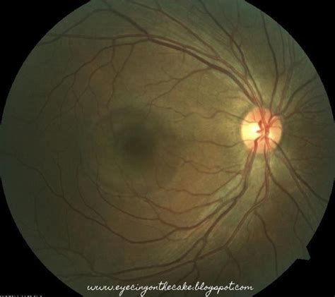 What Is Cscr Eye At Lance Upshaw Blog