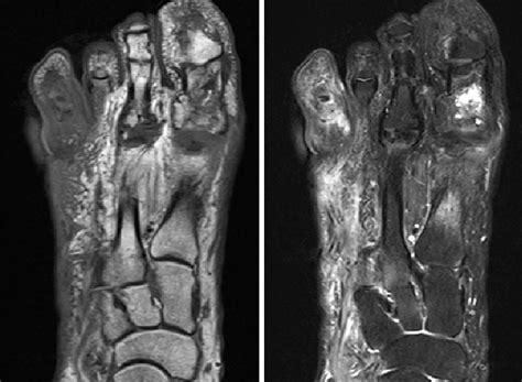 Magnetic Resonance Imaging Mri Of Diabetic Foot Ulcers Shows Bone