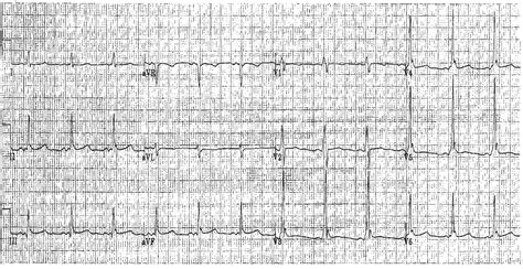 Atrial Flutter Ecg Interpretation With Examples Manual Of Medicine
