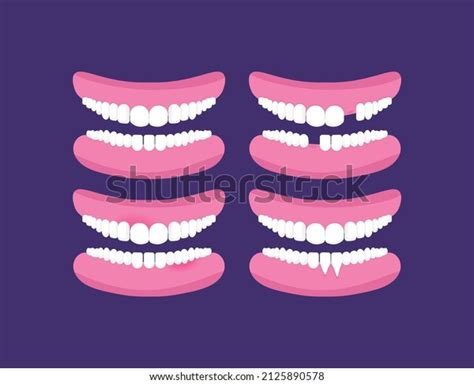 Vektor Stok Healthy Teeth Missing Teeth Gingivitis Gingival Tanpa Royalti 2125890578