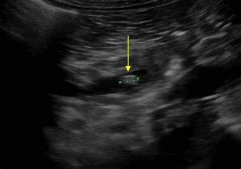 Abdomen And Retroperitoneum 12 Gallbladder And Bile Ducts Case 1215 Bile Duct Sludge And