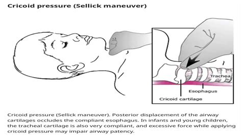 Rapid Sequence Intubation Rsi Pptx