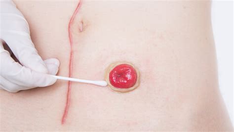 Loop Colostomy Ostomy Association Of Boston