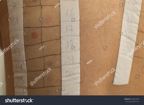 Photo De Stock Patch Test Allergic Reaction Allergic Contact 796657024 Shutterstock