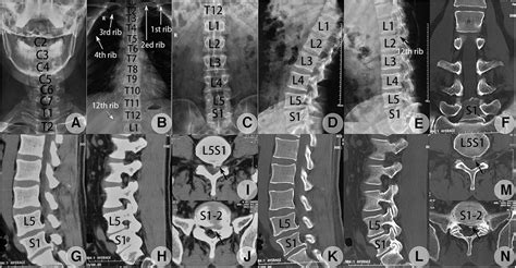 Frontiers Complete Lumbarization With Calcified Disc Herniations At L5s1 And S1 2 Levels