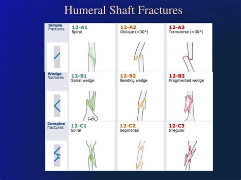 Ao Classification Of Humeral Shaft Fractures At Steven Obrien Blog