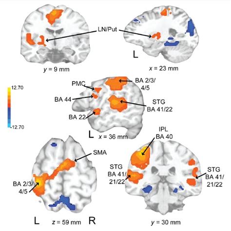 Brain Regions Where Bold Signal Was Significantly Different During