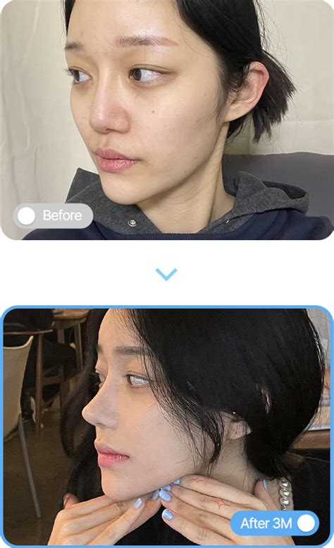 자려한 코성형 예쁘게 나답게 에이비 성형외과