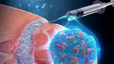 Hydrogel Shows Success Treating Severe Complication Of Crohns Disease