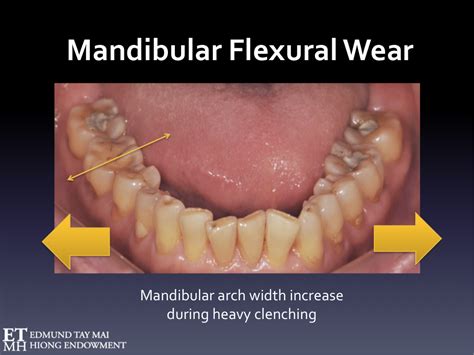 Awake Bruxism Ab And The Masseter Muscle Hypertrophy Controversy