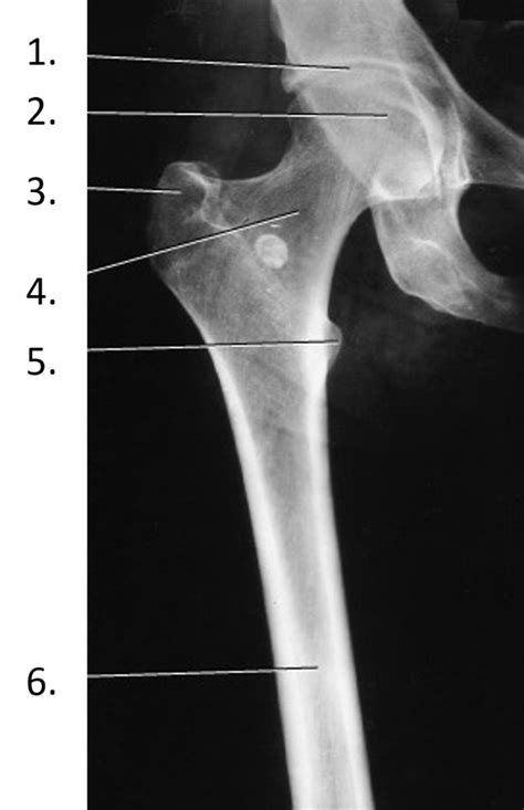 ap proximal femur diagram quizlet
