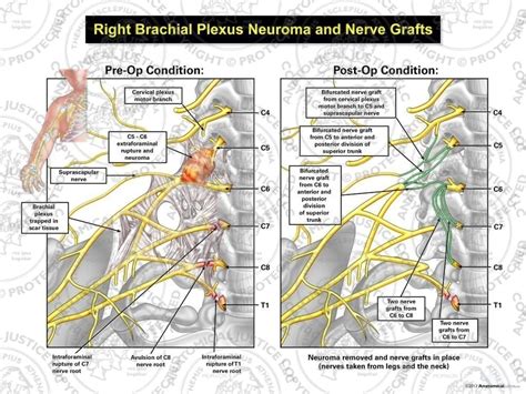 Right Brachial Plexus Neuroma And Nerve Grafts