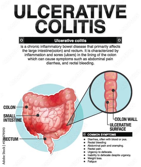 Ulcerative Colitis Symptoms Infographic Stock Vector Adobe Stock