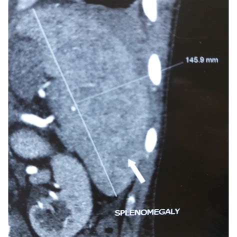 Sentinel Loop Sign And Colon Cut Off Sign In A Similar Plain Abdominal Download Scientific