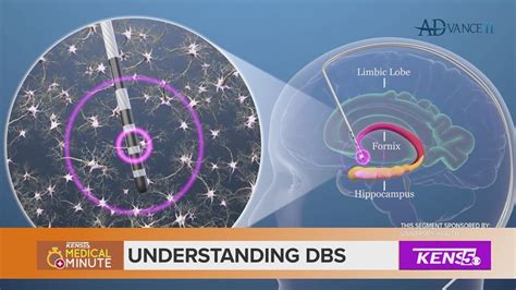 Benefits Of Deep Brain Stimulation Great Day Sa