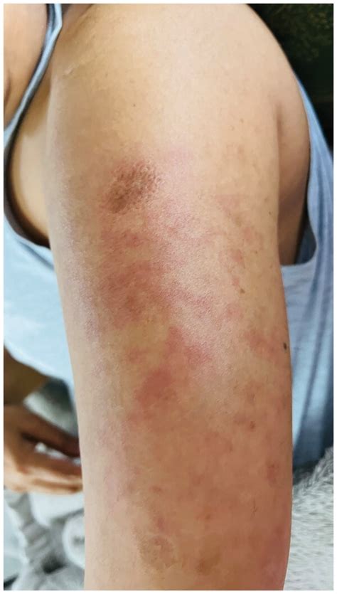 A Vasculitis Mimic During Pregnancy Autoimmune Progesterone Dermatitis