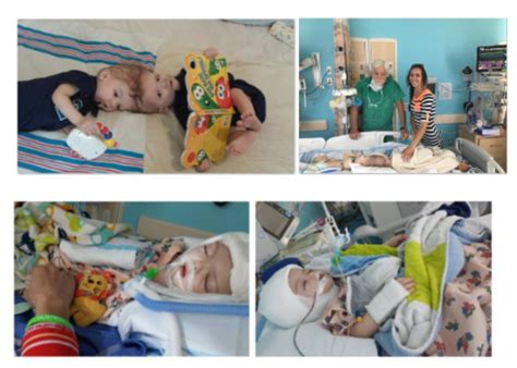 Craniopagus Twins Undergo Separation Surgery The Blazer
