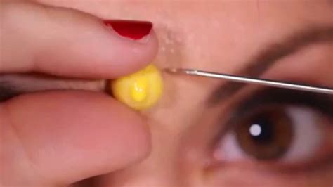 Blackhead Field Of Dreams Supercomedones And Dilated Pores Of Winer